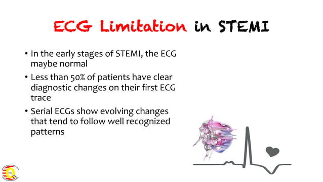 Module 5 tips and tricks- stemi ecg recognition & patterns finale | PPT