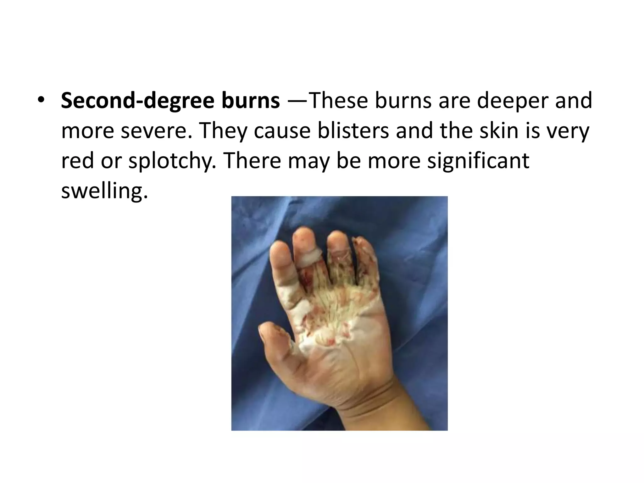 Module 5 Electric burn ppt final.pptx