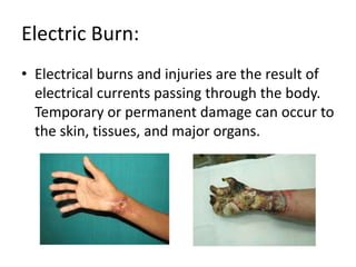 Module 5 Electric burn ppt final.pptx