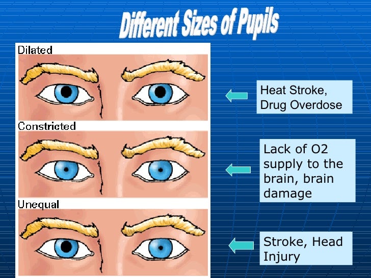 Possible causes unequal pupil size - wartery