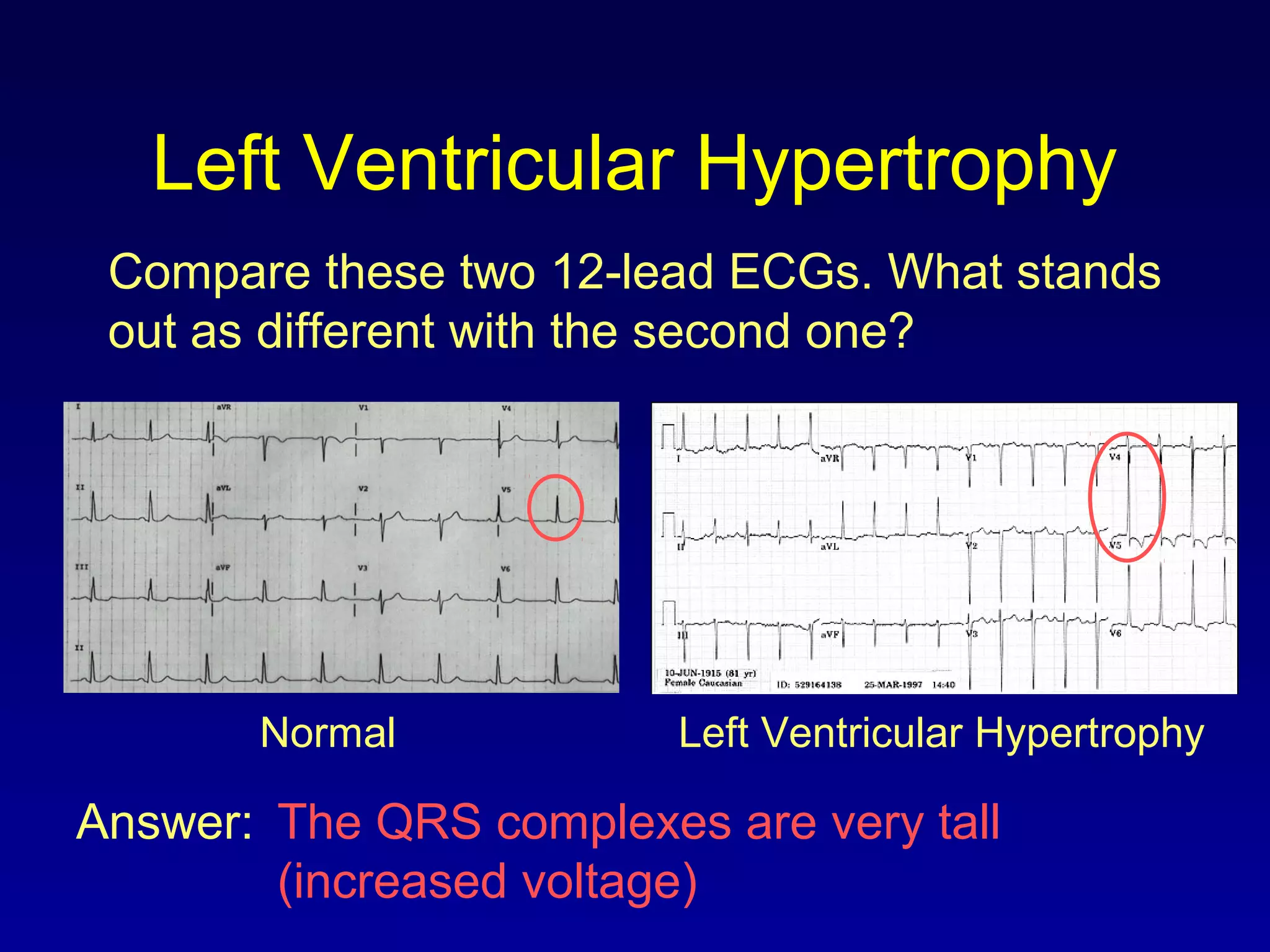 ECG PART 8 | PPT