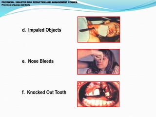 Module 6 Soft Tissue Injuries first aid training | PPT