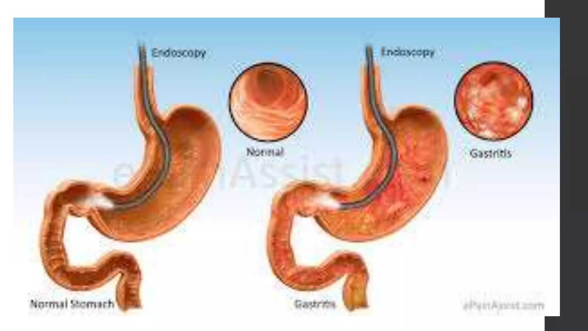 Gastrointestinal Pathophysiology | PPTX