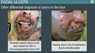 Module_7_Section_1_ULCER. Tropical derm.pdf