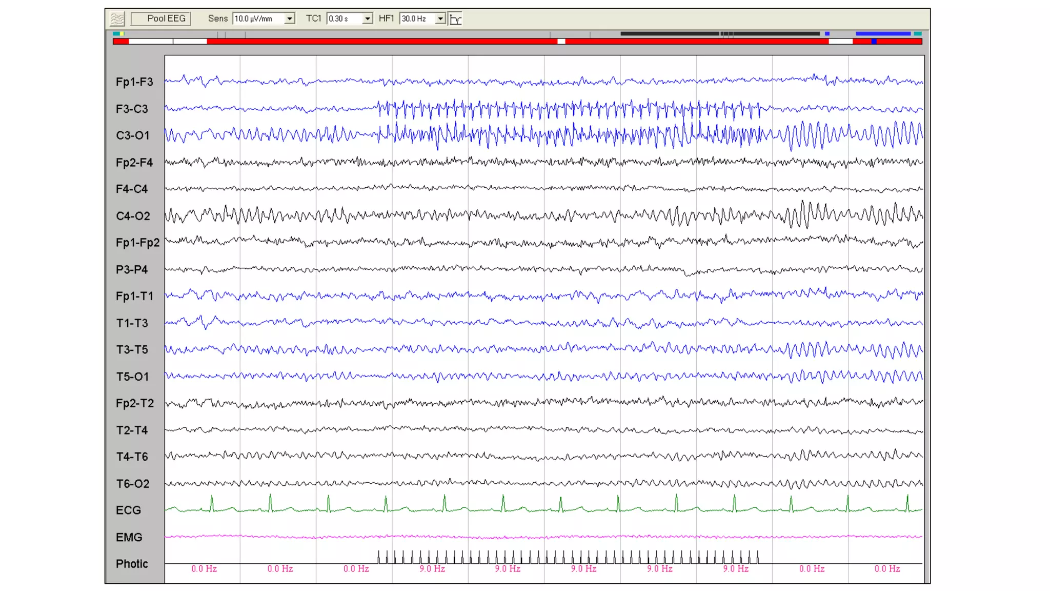 Activation Proceedures in EEG.pptx