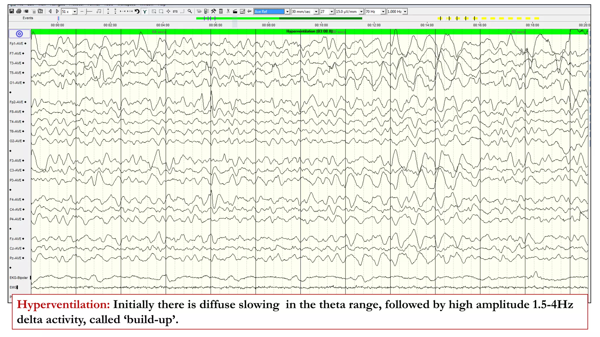 Activation Proceedures in EEG.pptx | Eye and Vision Conditions | Diseases and Conditions