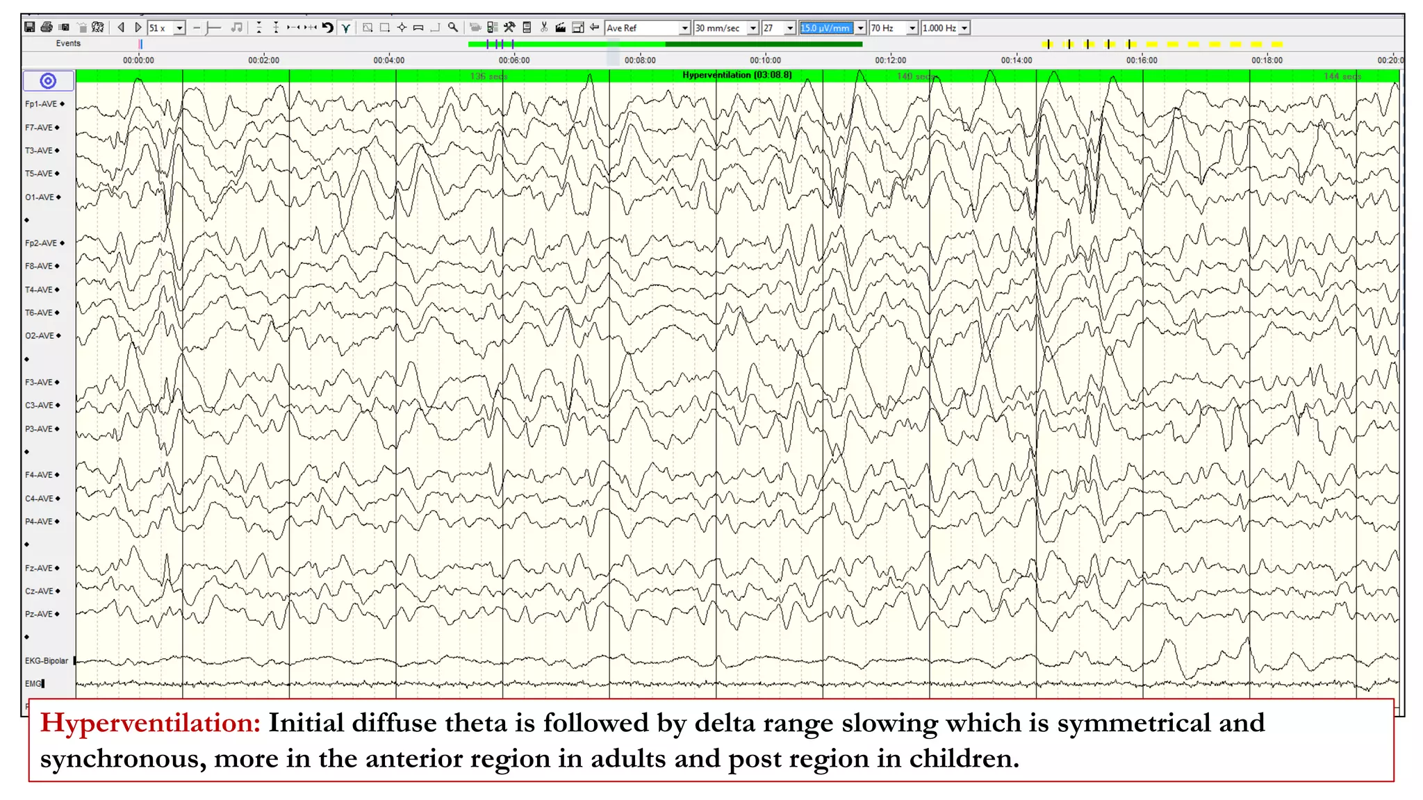 Activation Proceedures in EEG.pptx | Eye and Vision Conditions | Diseases and Conditions