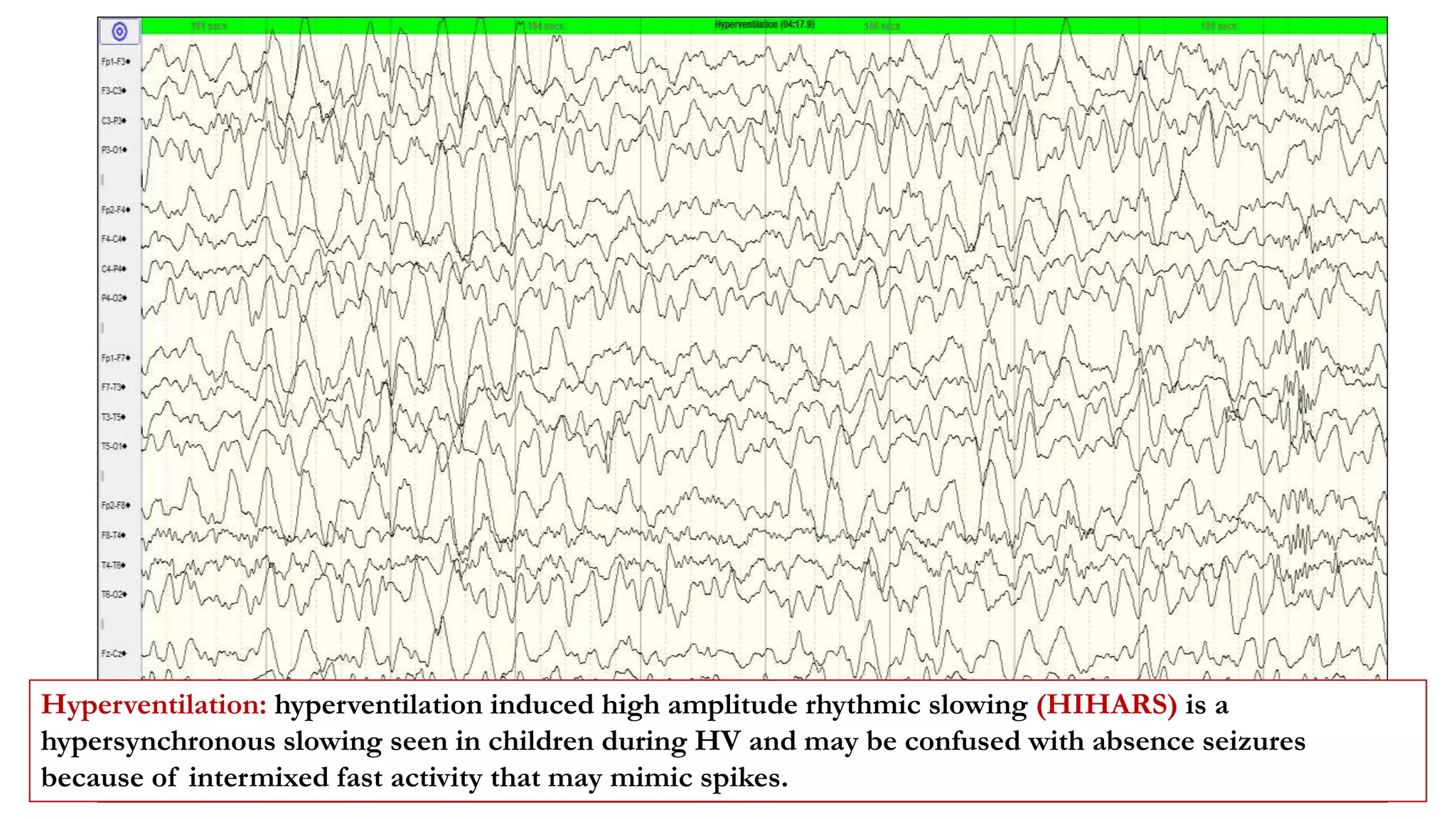 Activation Proceedures in EEG.pptx | Eye and Vision Conditions | Diseases and Conditions