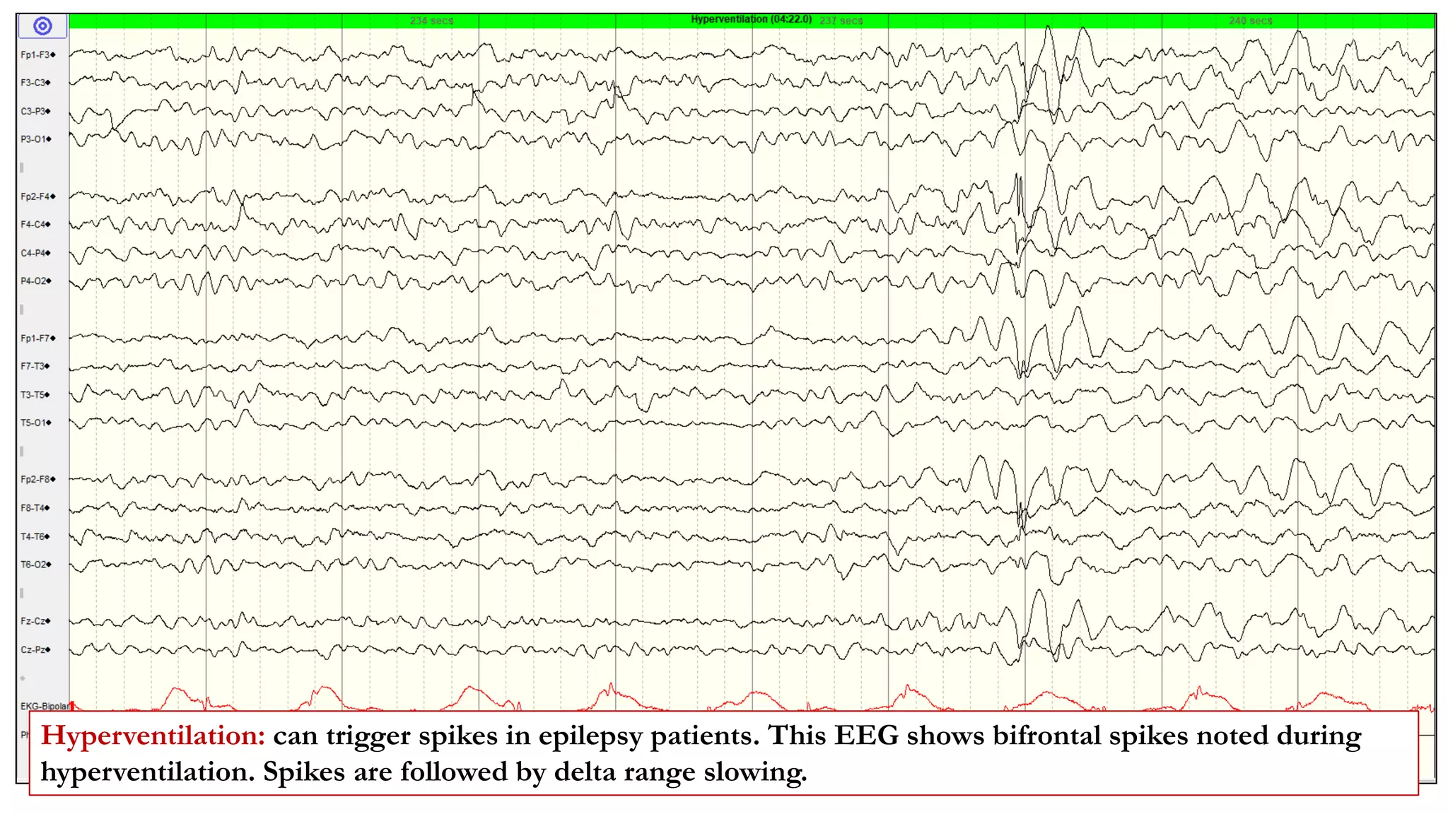 Activation Proceedures in EEG.pptx | Eye and Vision Conditions | Diseases and Conditions