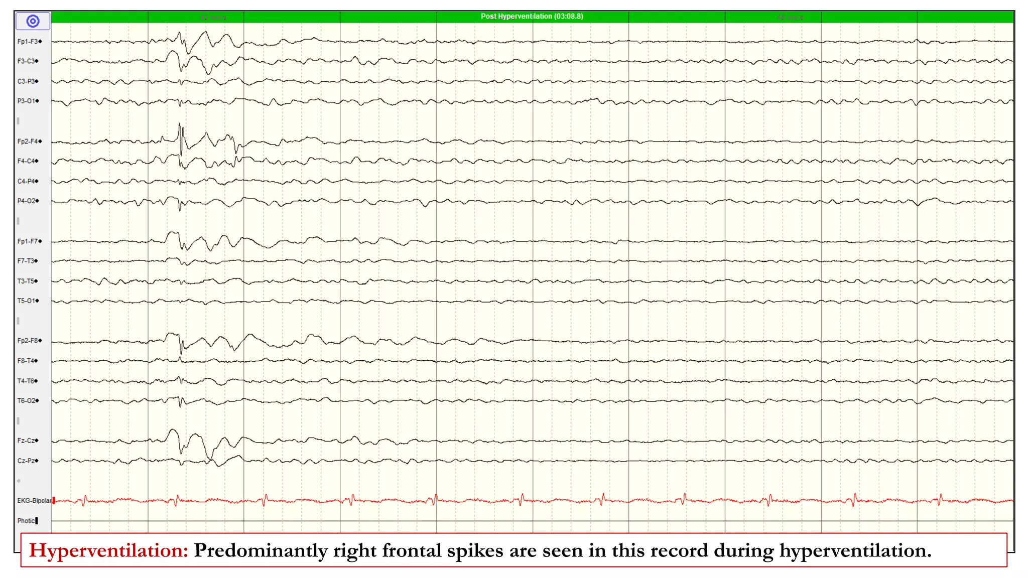 Activation Proceedures in EEG.pptx | Eye and Vision Conditions | Diseases and Conditions