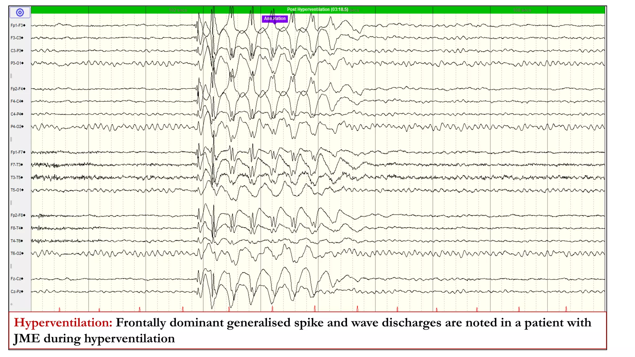 Activation Proceedures in EEG.pptx | Eye and Vision Conditions | Diseases and Conditions