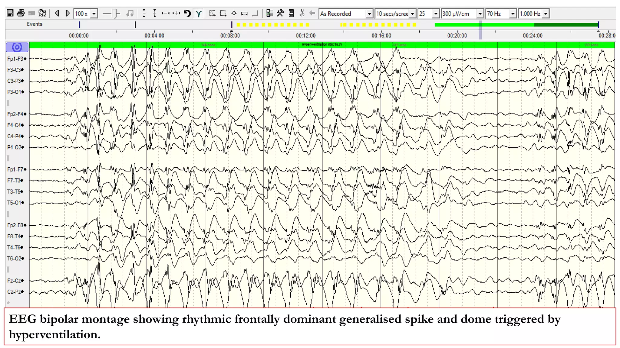 Activation Proceedures in EEG.pptx | Eye and Vision Conditions | Diseases and Conditions