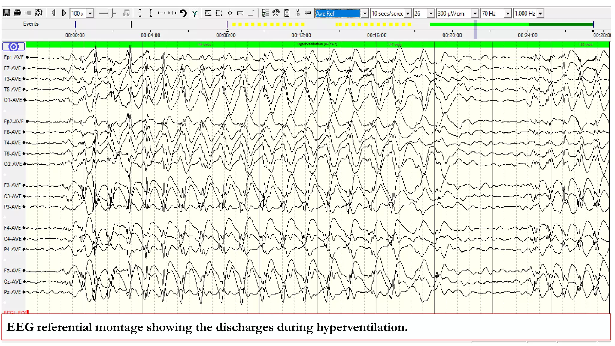 Activation Proceedures in EEG.pptx | Eye and Vision Conditions | Diseases and Conditions