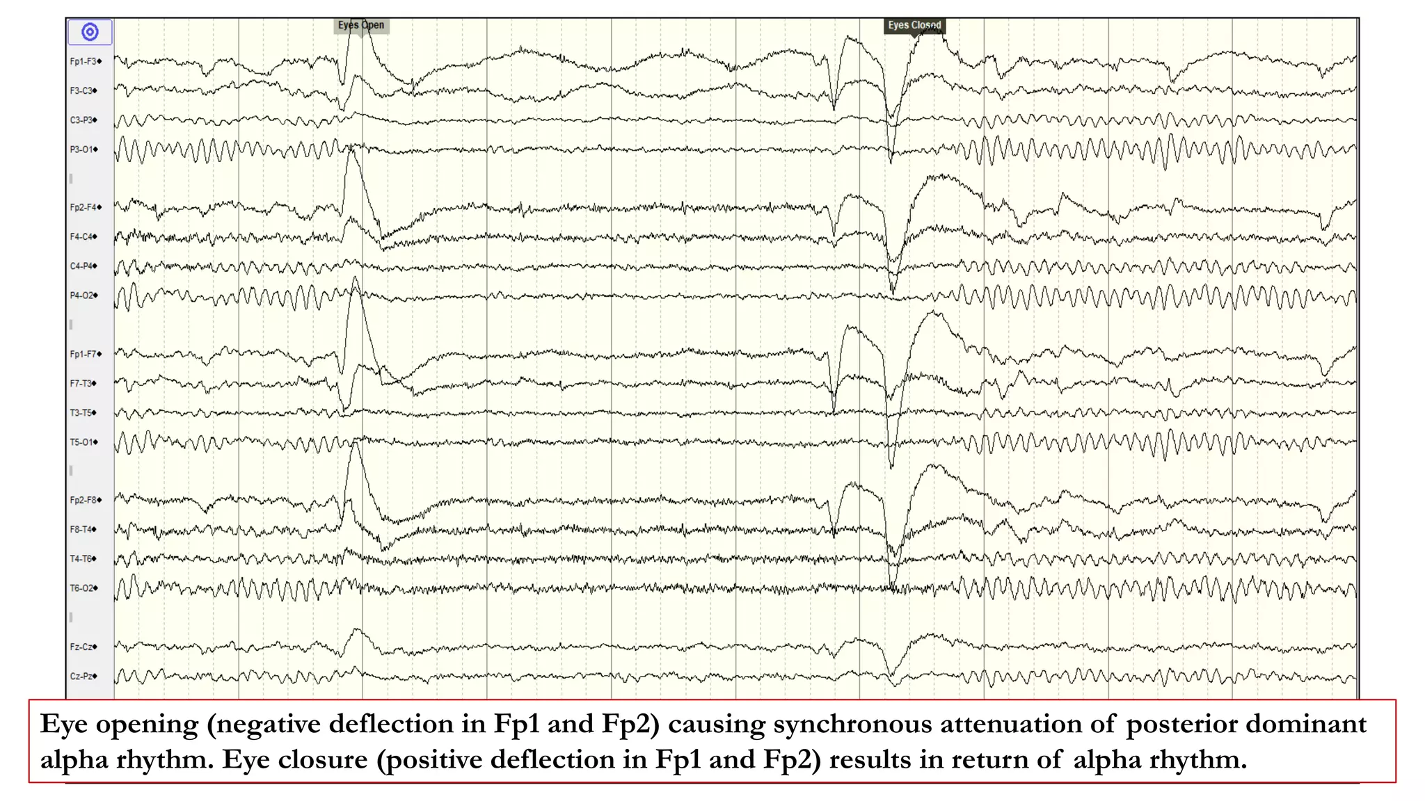Activation Proceedures in EEG.pptx