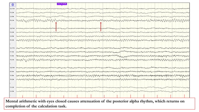 Activation Proceedures in EEG.pptx | Eye and Vision Conditions ...