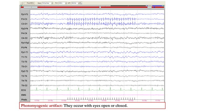 Activation Proceedures in EEG.pptx | Eye and Vision Conditions ...