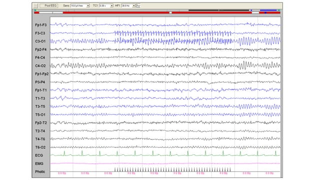Activation Proceedures in EEG.pptx | Eye and Vision Conditions ...