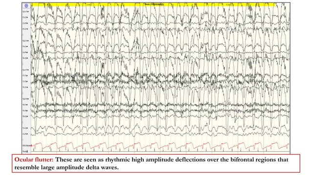 Activation Proceedures in EEG.pptx | Eye and Vision Conditions | Diseases and Conditions