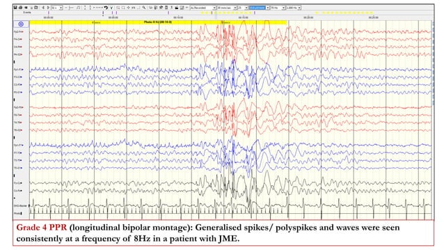 Activation Proceedures in EEG.pptx | Eye and Vision Conditions | Diseases and Conditions