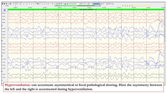 Activation Proceedures in EEG.pptx | Eye and Vision Conditions | Diseases and Conditions