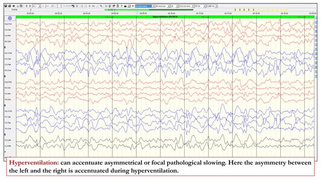 Activation Proceedures in EEG.pptx | Eye and Vision Conditions | Diseases and Conditions