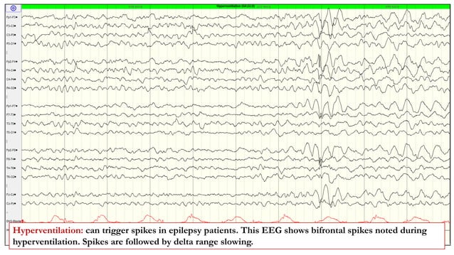 Activation Proceedures in EEG.pptx | Eye and Vision Conditions | Diseases and Conditions
