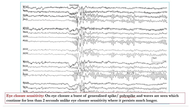 Activation Proceedures in EEG.pptx | Eye and Vision Conditions ...