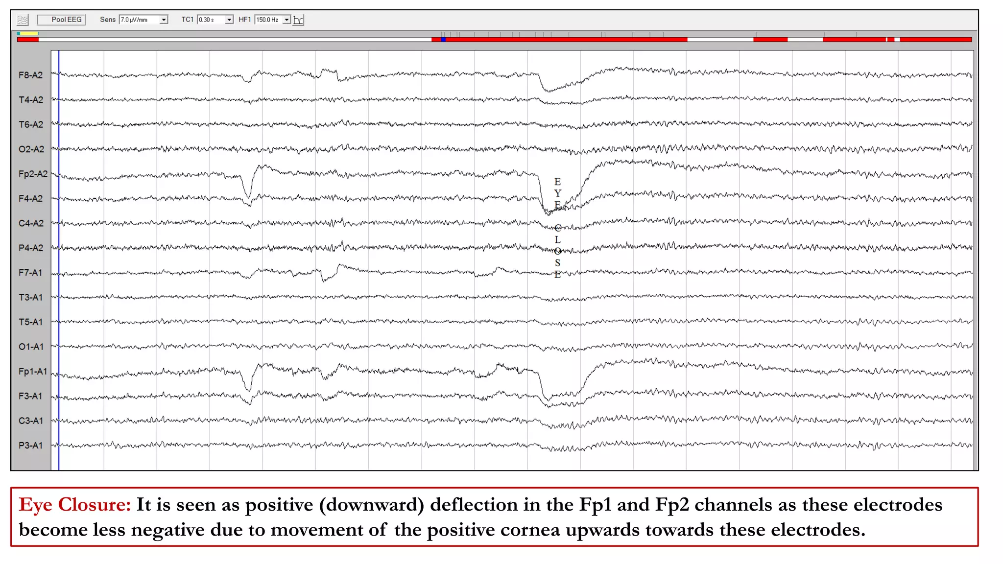 Artifacts in EEG.pptx