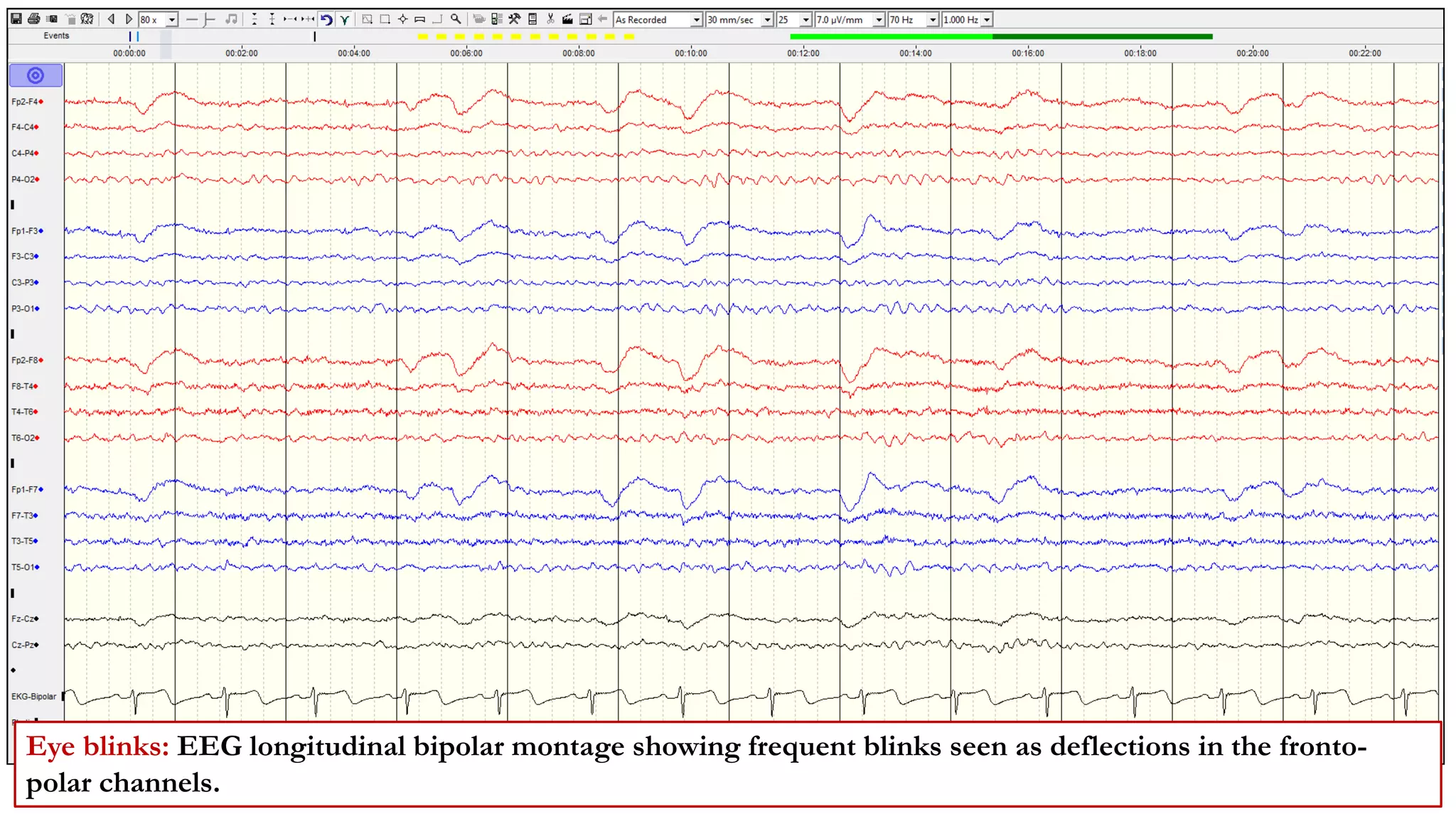 Artifacts in EEG.pptx | Eye and Vision Conditions | Diseases and Conditions