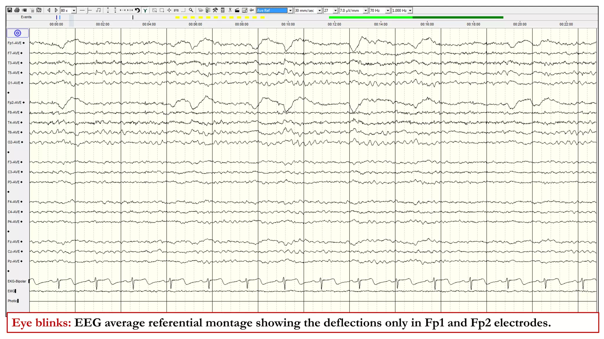Artifacts in EEG.pptx