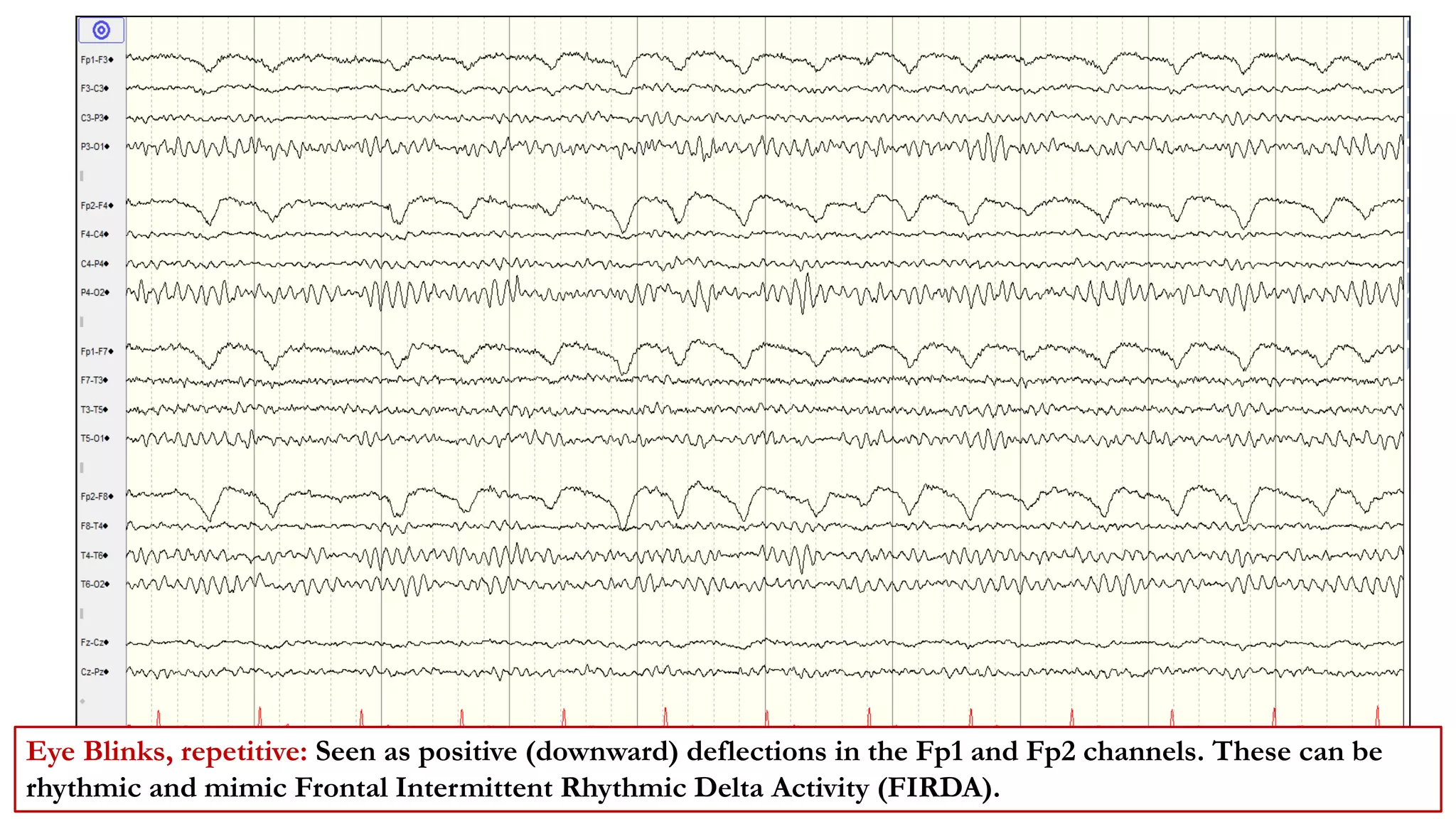 Artifacts in EEG.pptx | Eye and Vision Conditions | Diseases and Conditions