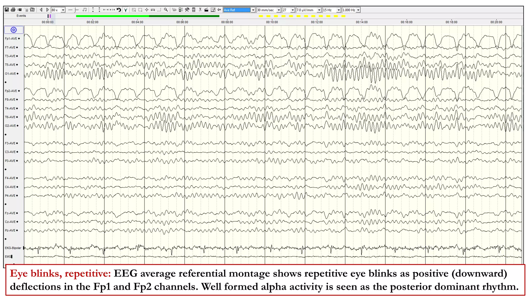 Artifacts in EEG.pptx | Eye and Vision Conditions | Diseases and Conditions