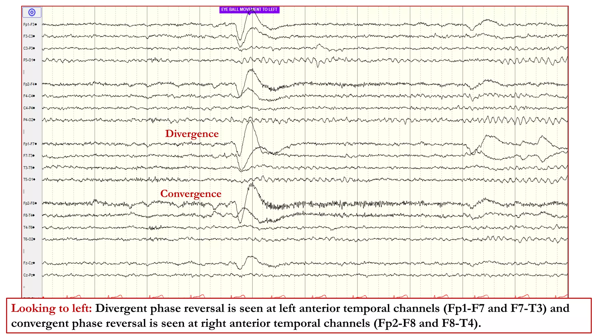 Artifacts in EEG.pptx