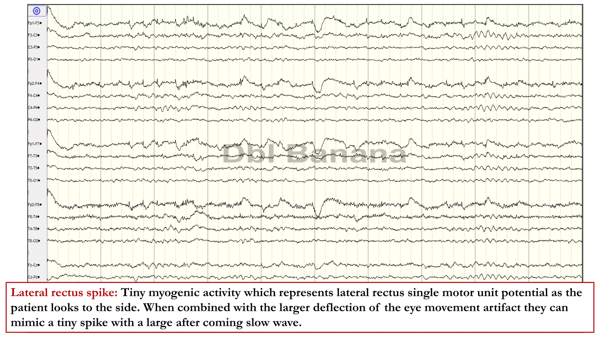 Artifacts in EEG.pptx