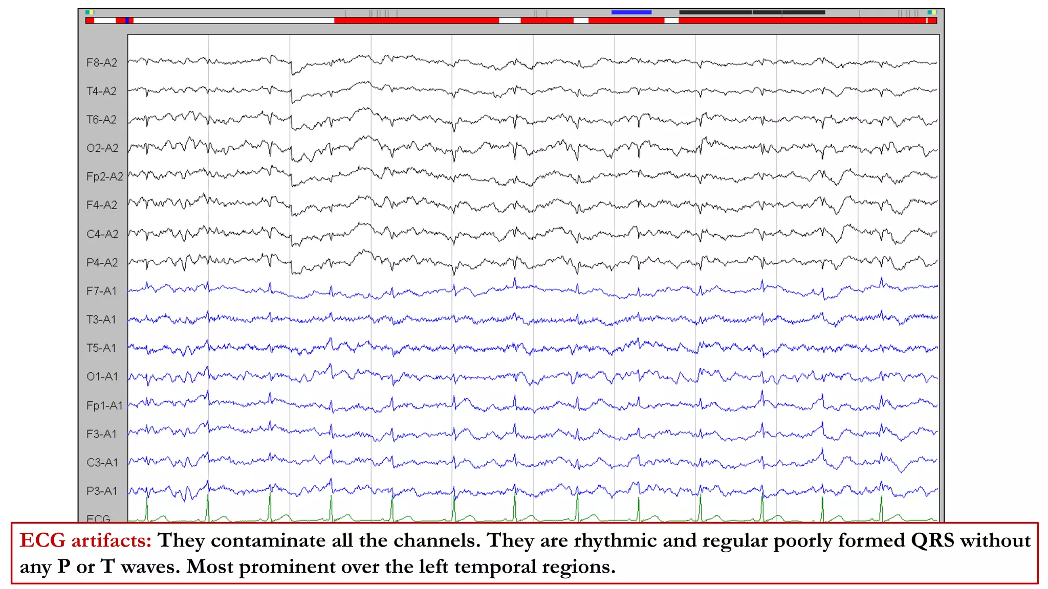 Artifacts in EEG.pptx | Eye and Vision Conditions | Diseases and Conditions