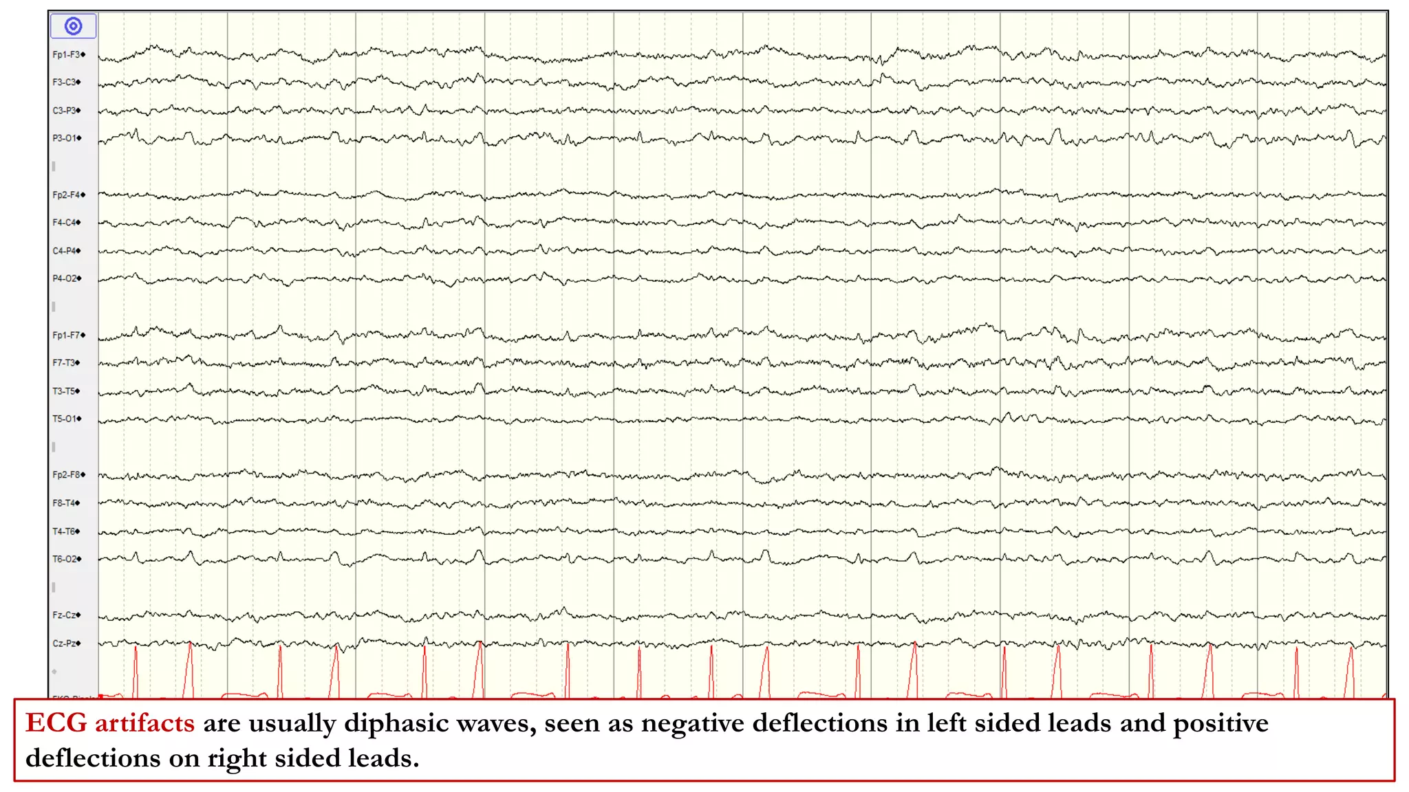 Artifacts in EEG.pptx
