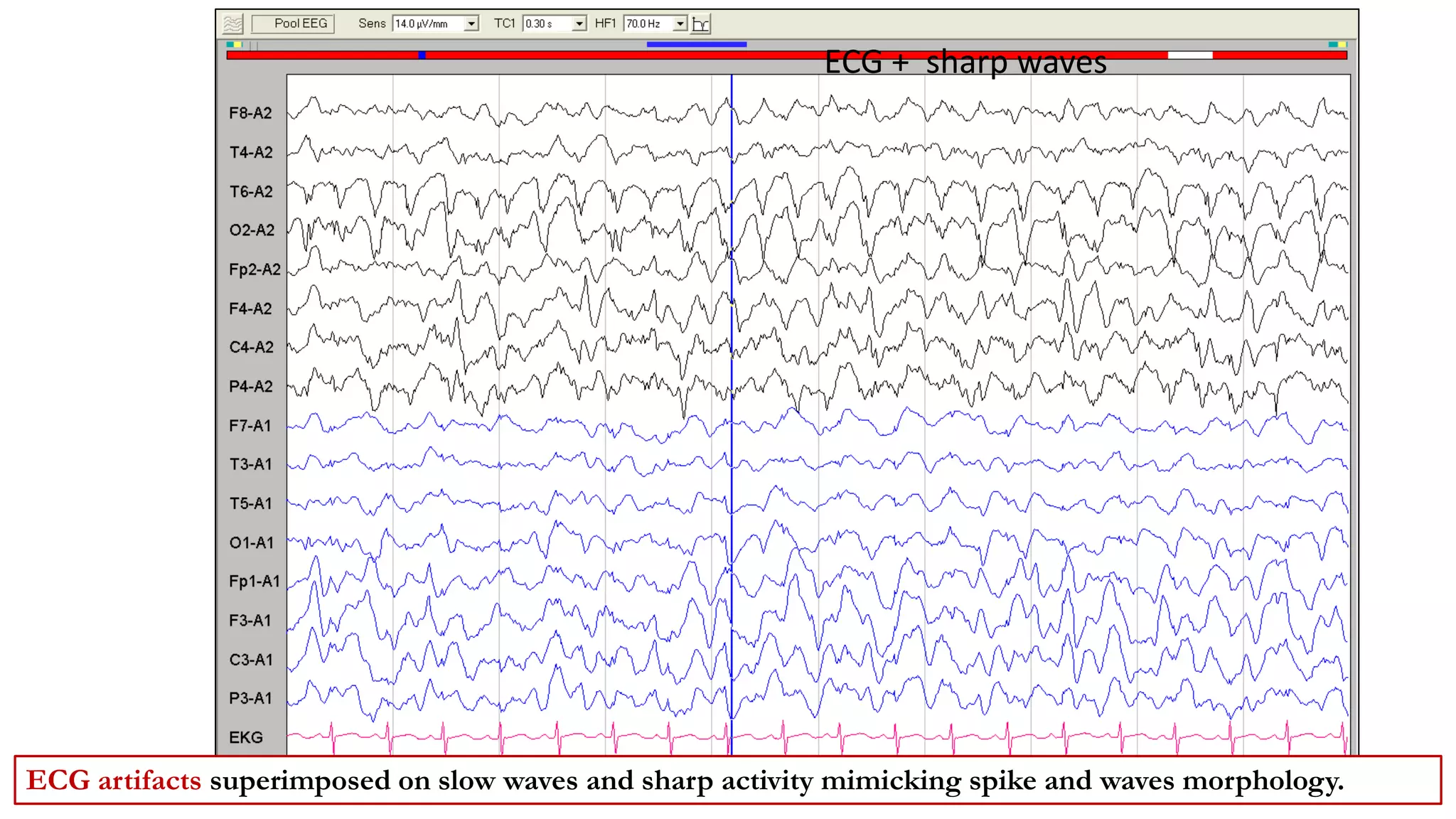 Artifacts in EEG.pptx