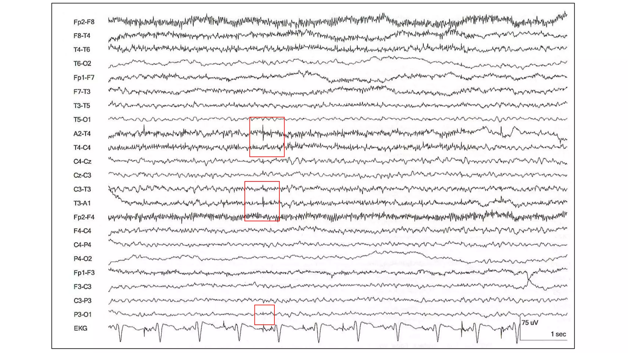 Artifacts in EEG.pptx | Eye and Vision Conditions | Diseases and Conditions