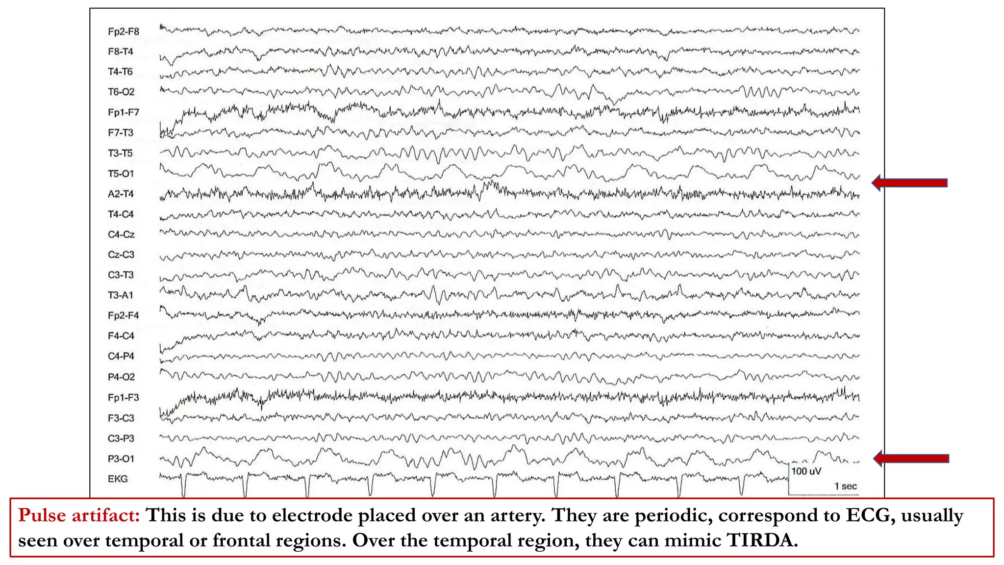 Artifacts in EEG.pptx