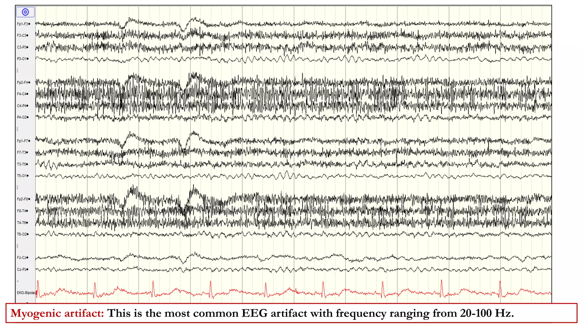 Artifacts in EEG.pptx | Eye and Vision Conditions | Diseases and Conditions