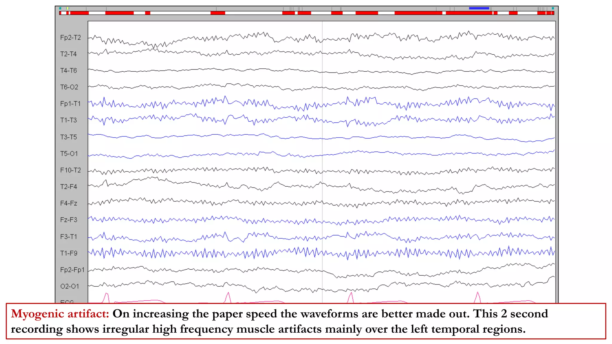 Artifacts in EEG.pptx | Eye and Vision Conditions | Diseases and Conditions