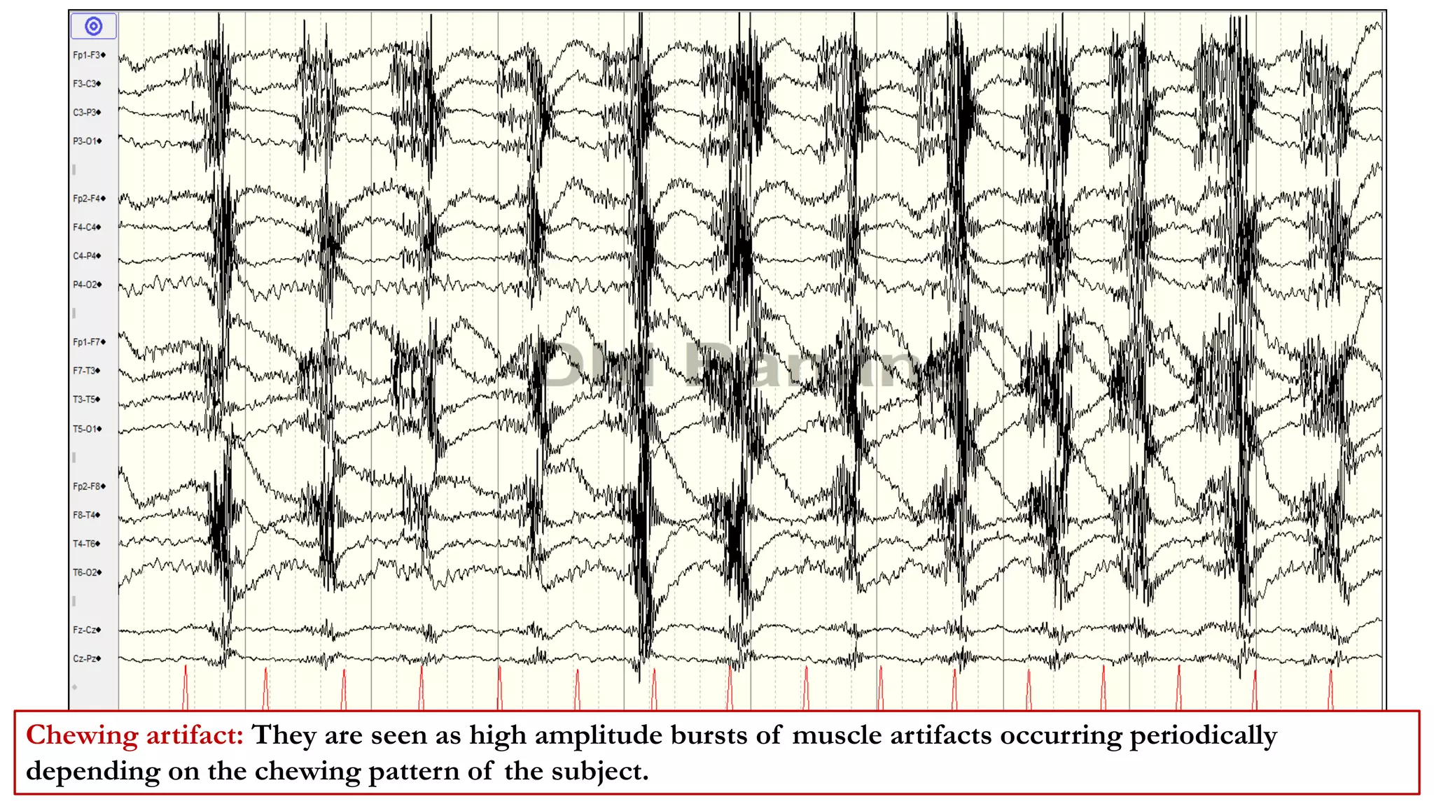 Artifacts in EEG.pptx