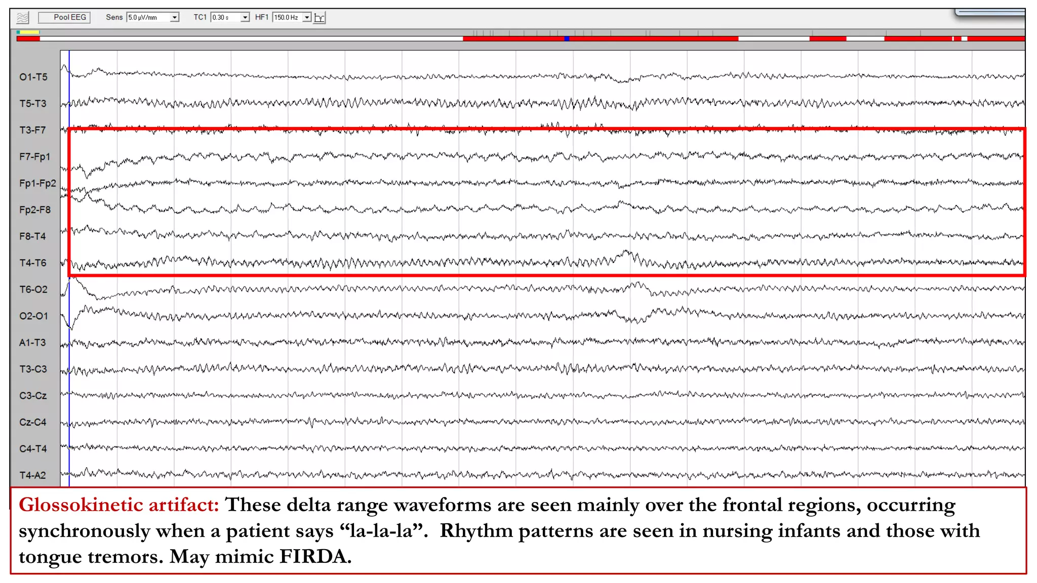Artifacts in EEG.pptx | Eye and Vision Conditions | Diseases and Conditions