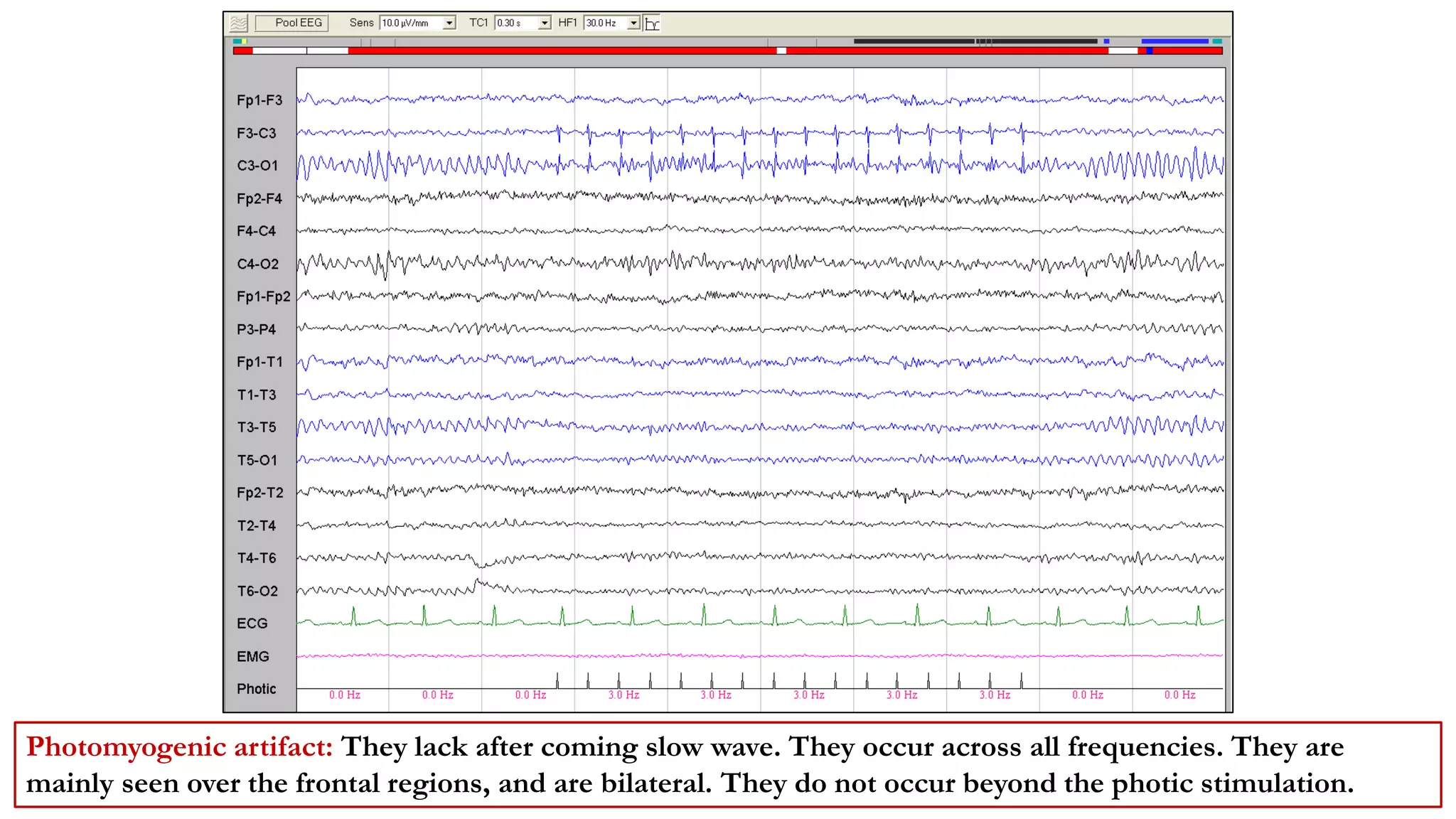 Artifacts in EEG.pptx | Eye and Vision Conditions | Diseases and Conditions