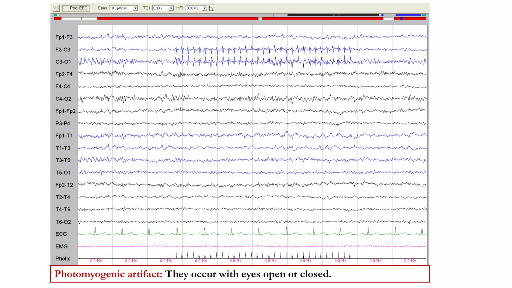 Artifacts in EEG.pptx | Eye and Vision Conditions | Diseases and Conditions