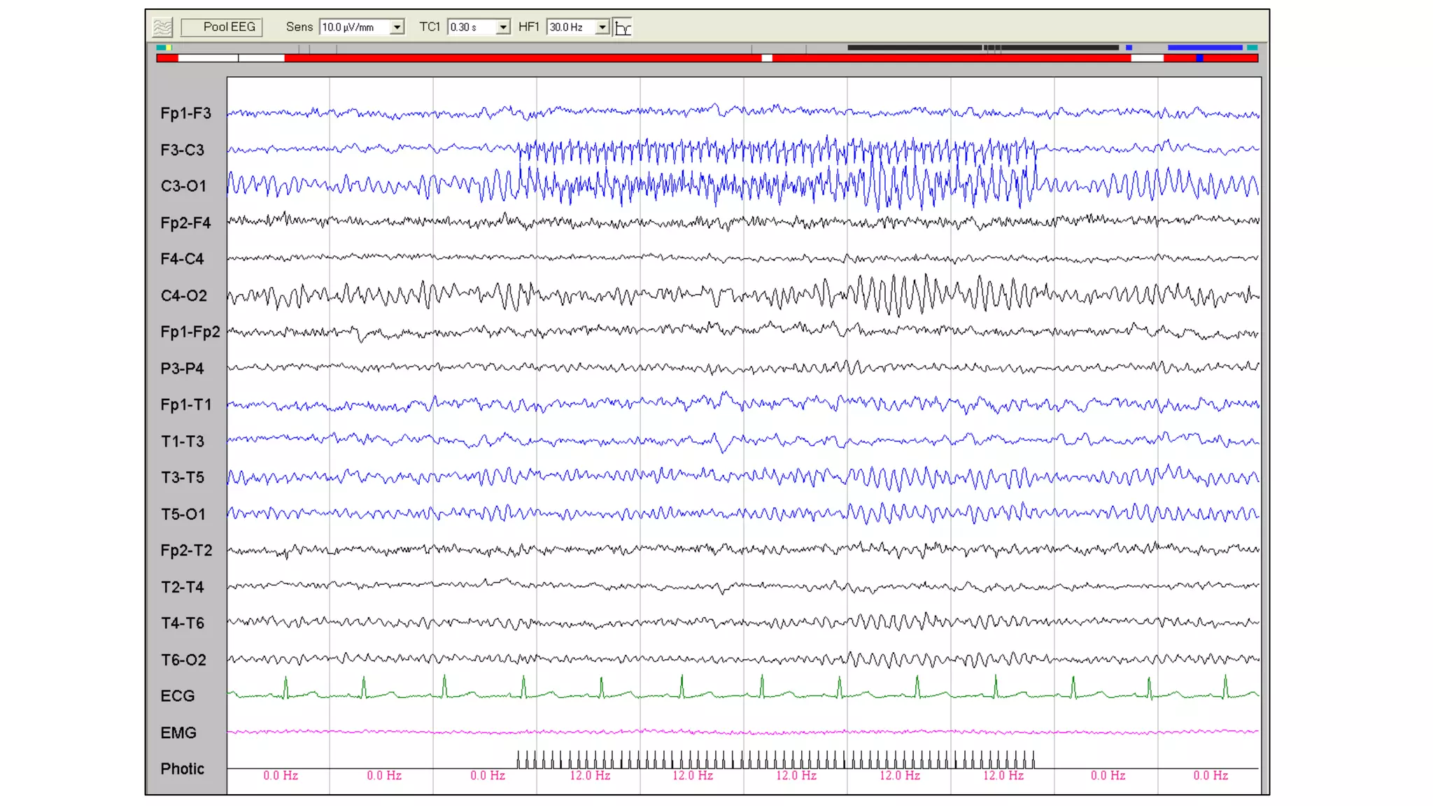 Artifacts in EEG.pptx | Eye and Vision Conditions | Diseases and Conditions