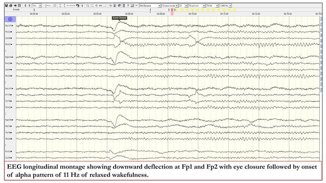 Artifacts in EEG.pptx | Eye and Vision Conditions | Diseases and Conditions