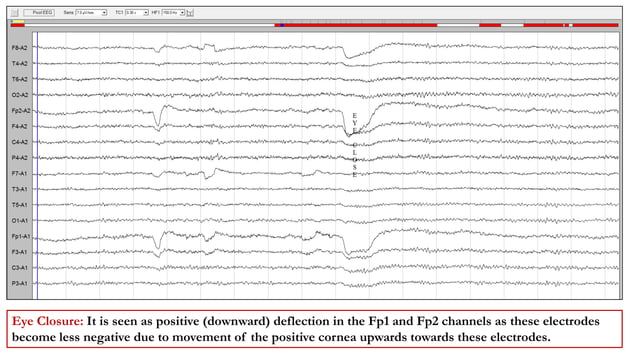 Artifacts in EEG.pptx | Eye and Vision Conditions | Diseases and Conditions