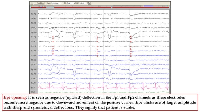 Artifacts in EEG.pptx | Eye and Vision Conditions | Diseases and Conditions