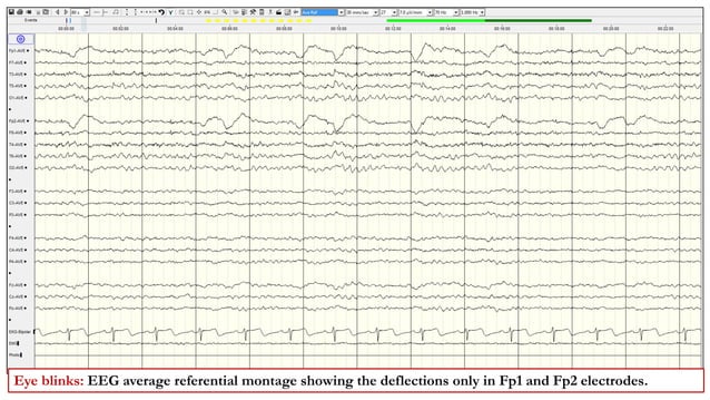 Artifacts in EEG.pptx | Eye and Vision Conditions | Diseases and Conditions